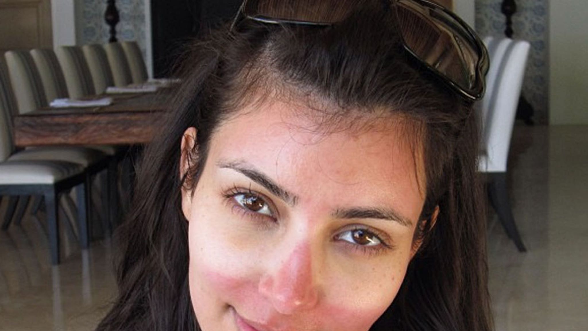 Celebrity Sunburns -- Guess Who!