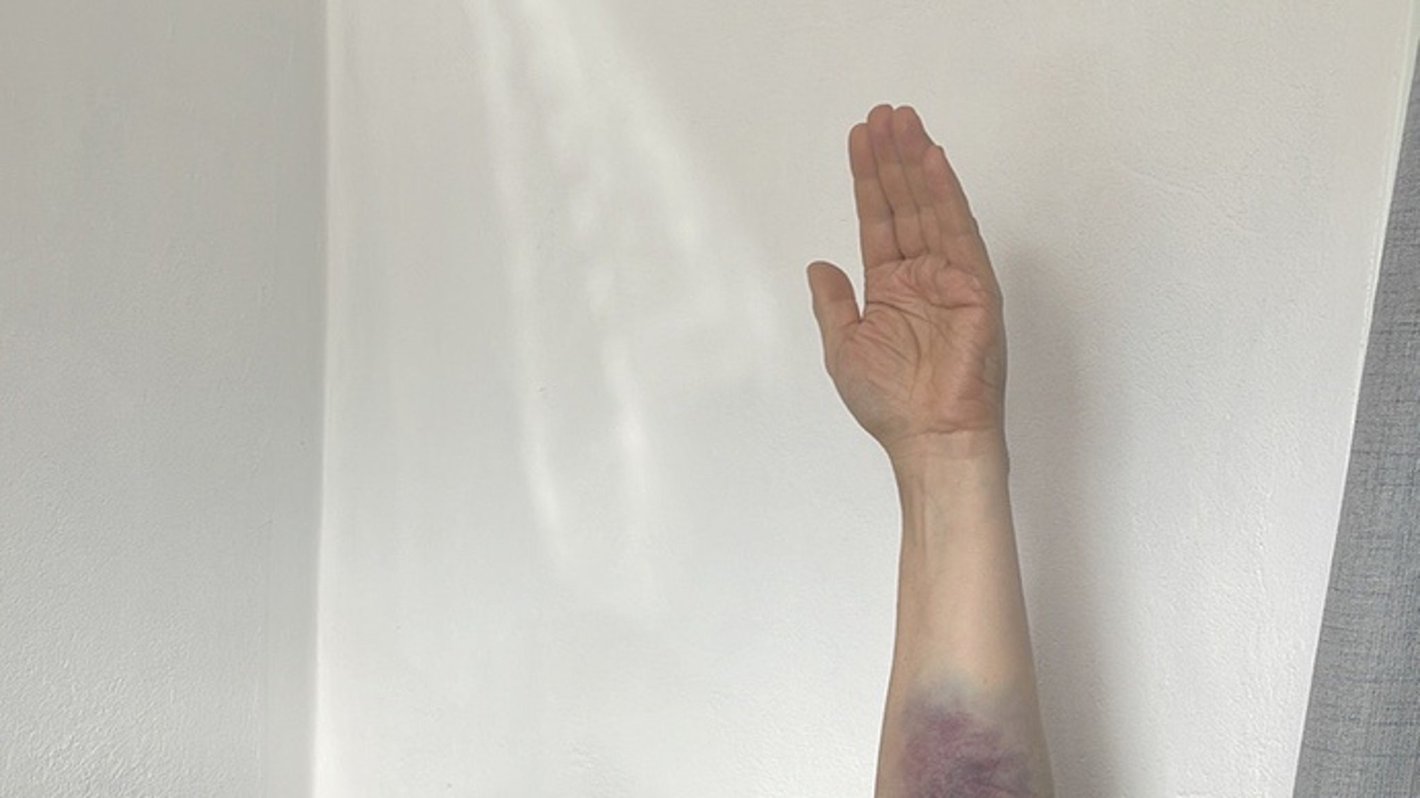 Hippo Bite Injury -- Graphic Photos