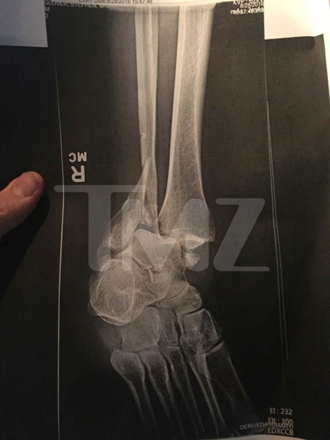 Steve-O's Foot Injury Photos