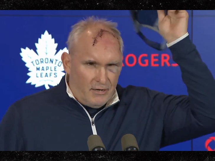 Toronto Maple Leafs Coach Craig Berube Reveals Nasty Scar From Gym Accident