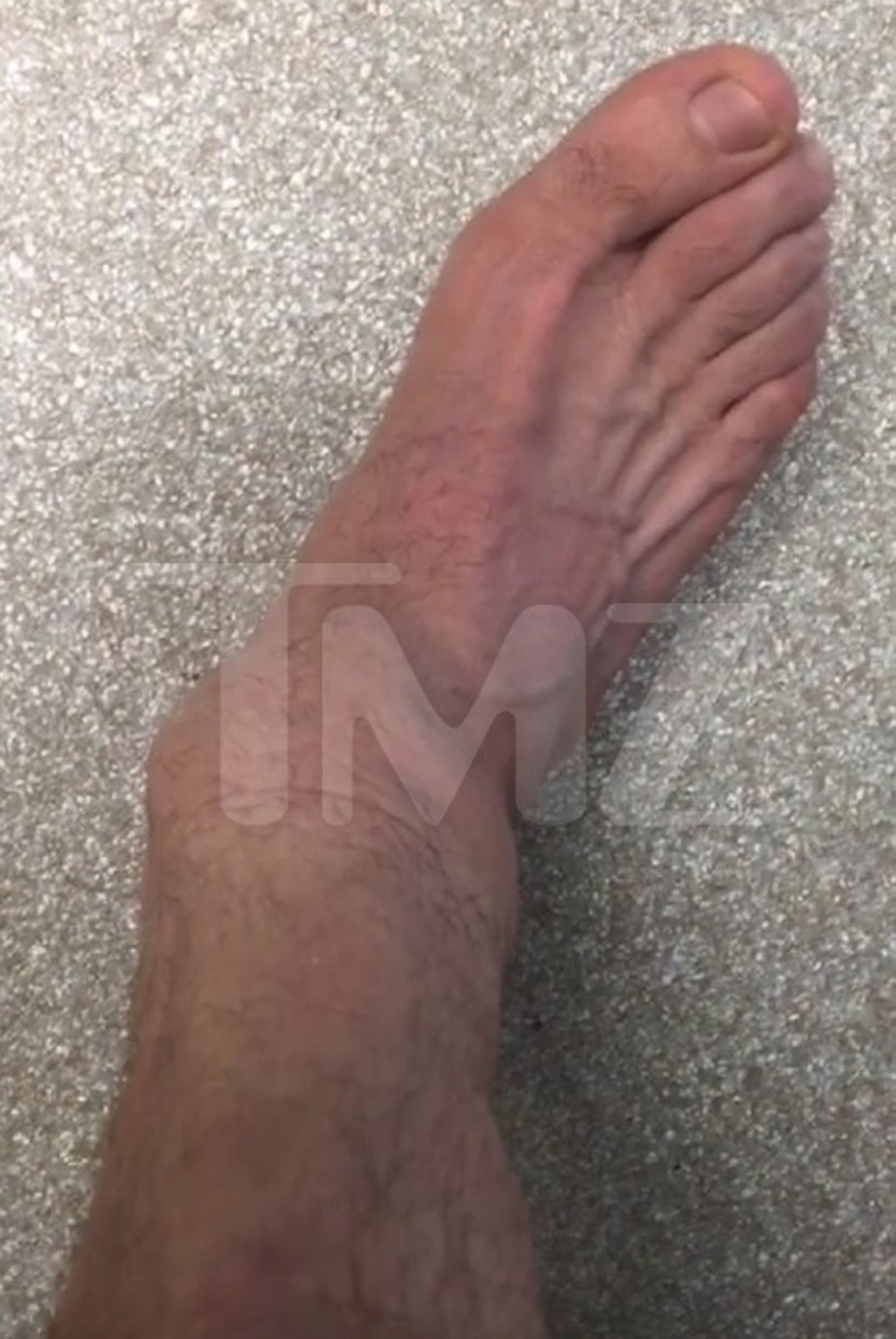 Steve-O's Foot Injury Photos