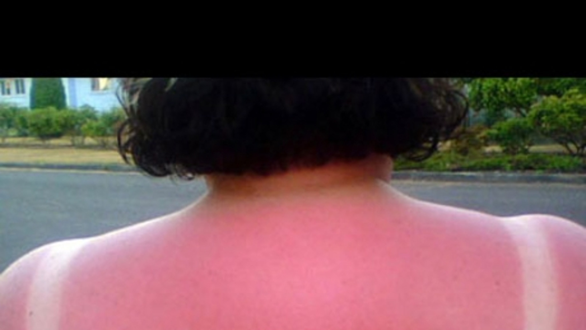 TMZ's Summer Sunburn Snapshots Contest