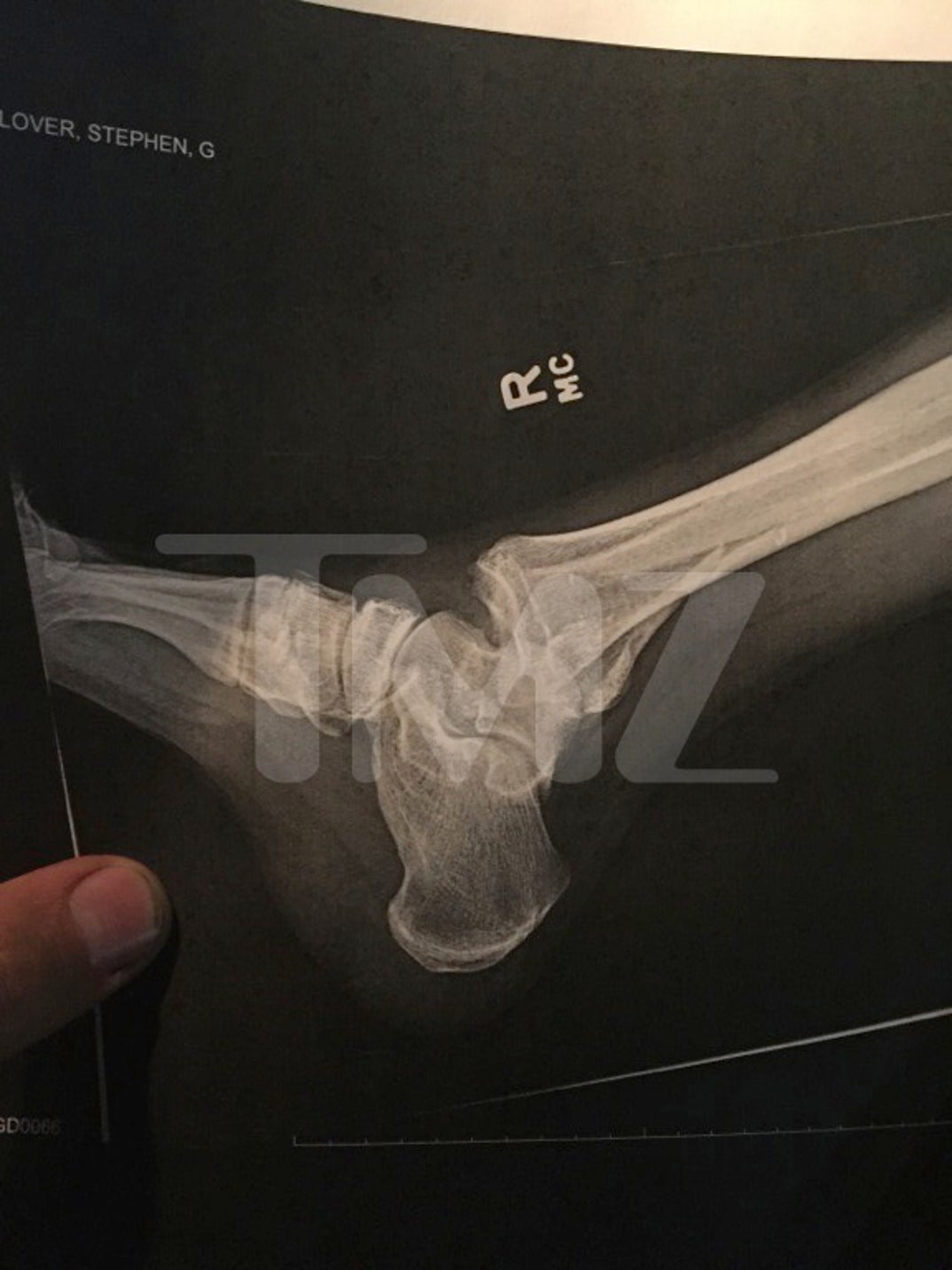 Steve-O's Foot Injury Photos